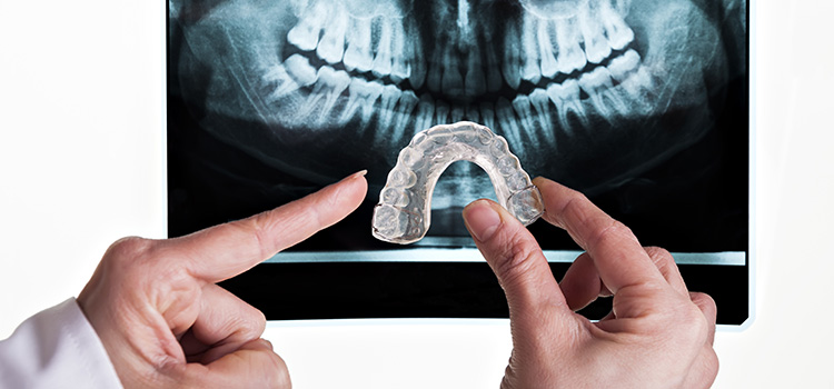 Michigan Splint - Pro Teeth Guard