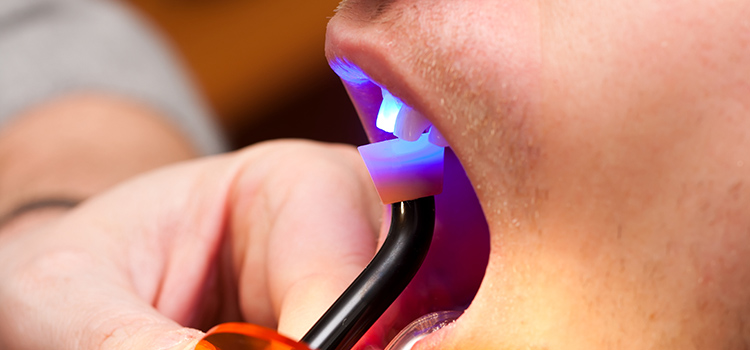 How To Repair Teeth Grinding Damage? - Pro Teeth Guard