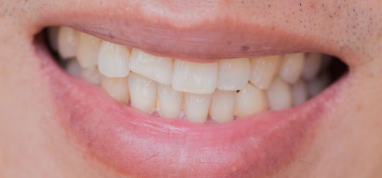 Short Teeth? Causes, Fixes, and How to Prevent More Wear - Pro Teeth Guard