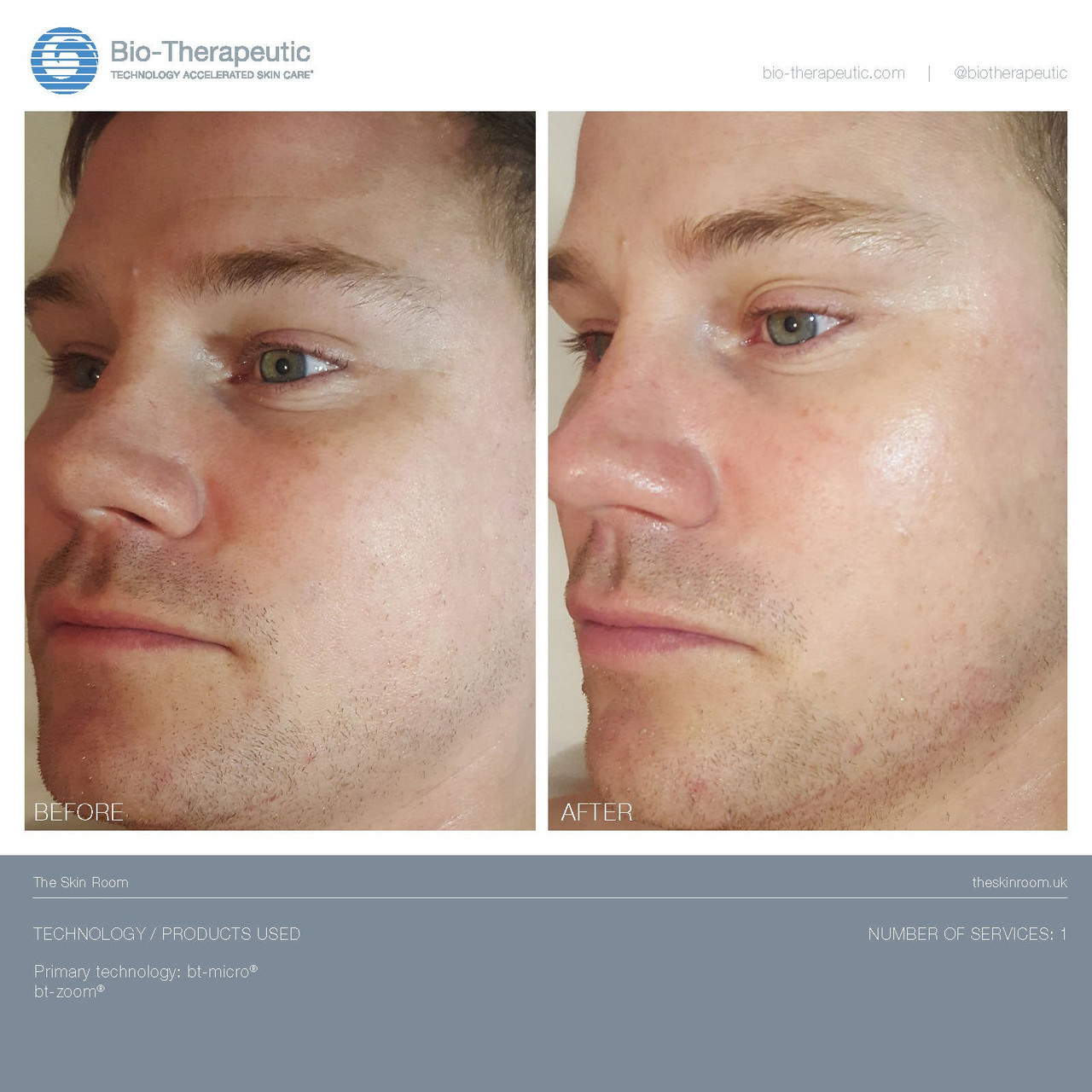 Bio-Therapeutic bt-micro Ultrasonic Skin Technology