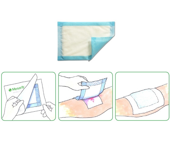 Molnlycke Mesorb Absorbent Dressing (Pack of 10) - Selles Medical