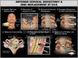 Anterior Cervical Discectomy & Replacement at C5-6 - Print Quality ...