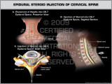 Epidural Steroid Injection of Cervical Spine