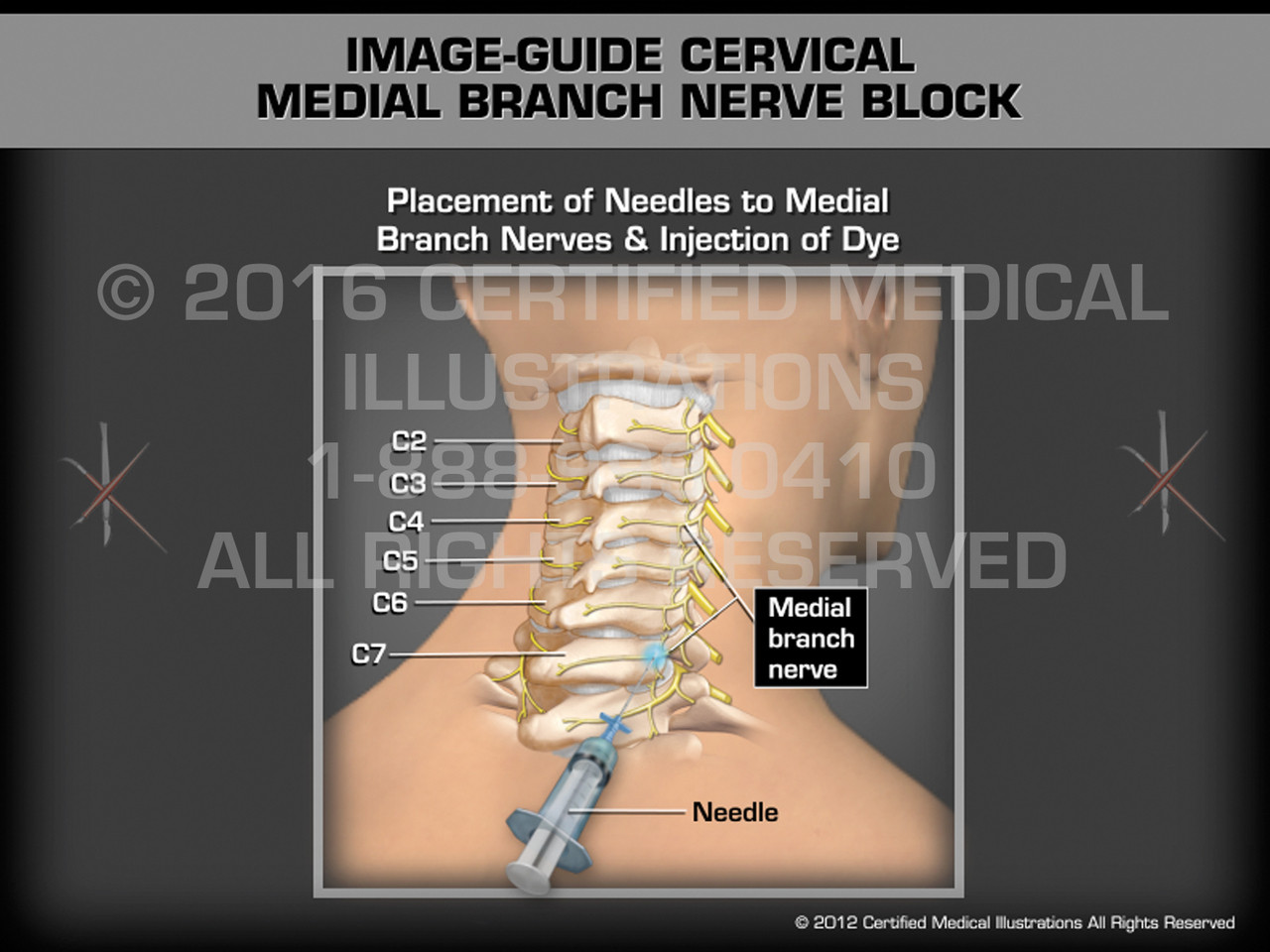 Image-Guide Cervical Medial Branch Nerve Block - Medical Animation