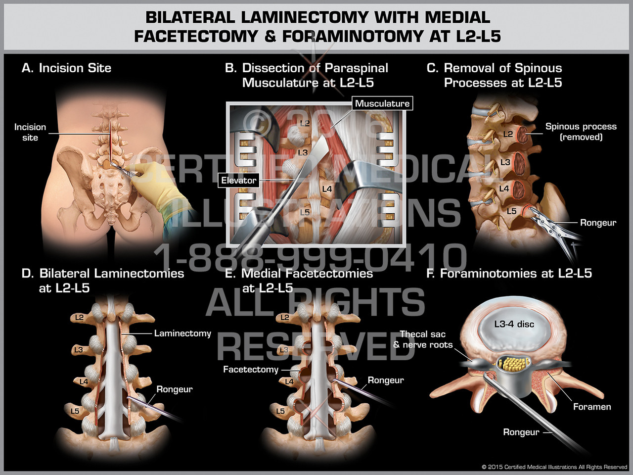 Bilateral Laminectomy with Medial Facetectomy & Foraminotomy at L2-L5