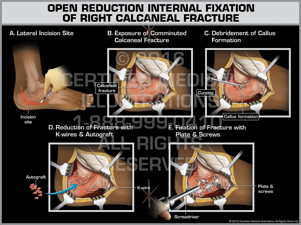 Open Reduction Internal Fixation of Right Calcaneal Fracture - Print ...