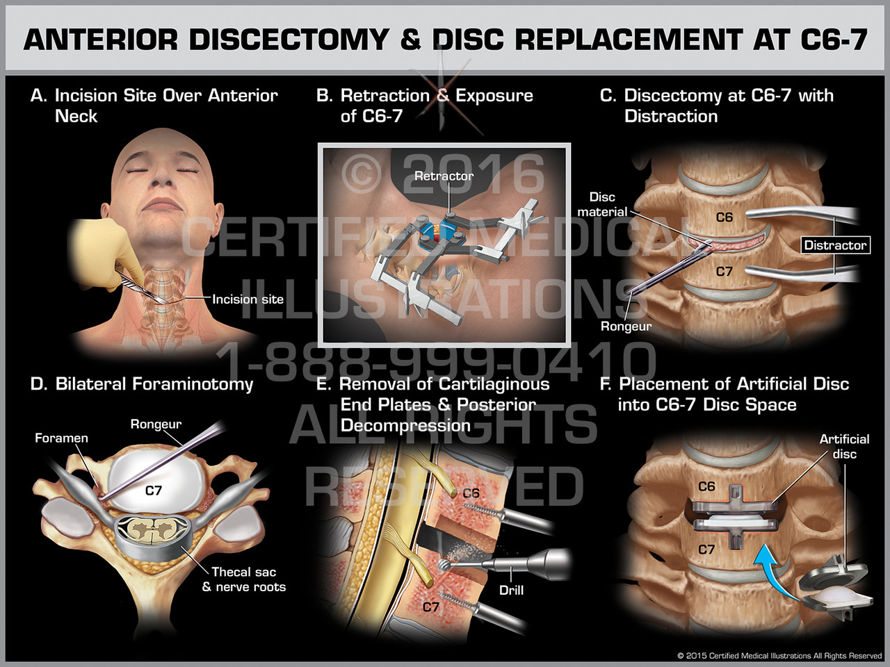 Anterior Discectomy & Disc Replacement at C6-7 - Print Quality Instant ...