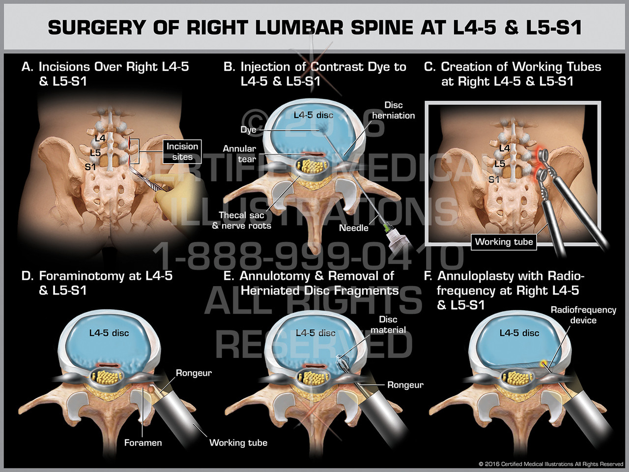 Surgery of Right Lumbar Spine at L4-5 & L5-S1 - Print Quality Instant ...