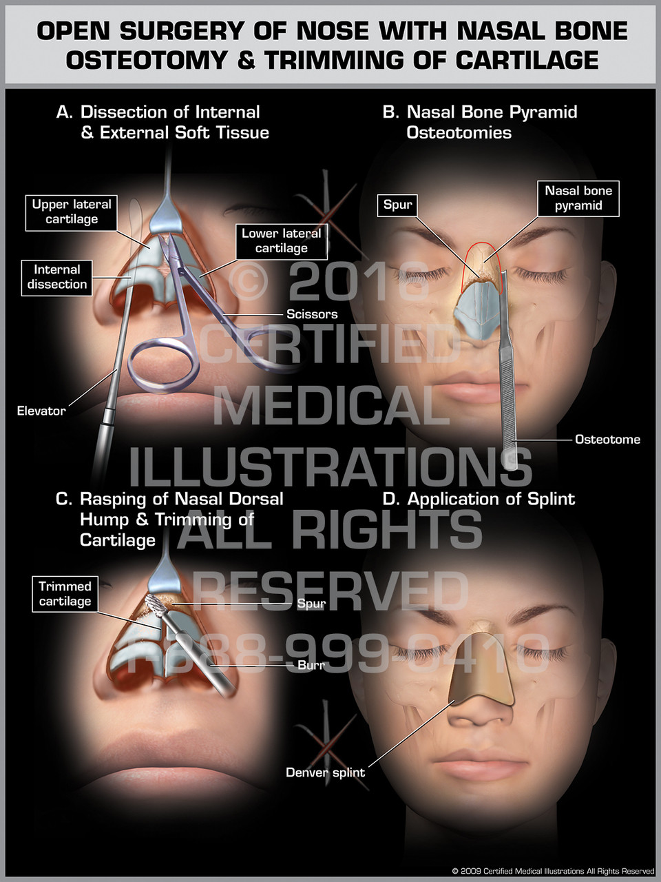 Open Surgery of Nose with Nasal Bone Osteotomy & Trimming of Cartilage ...