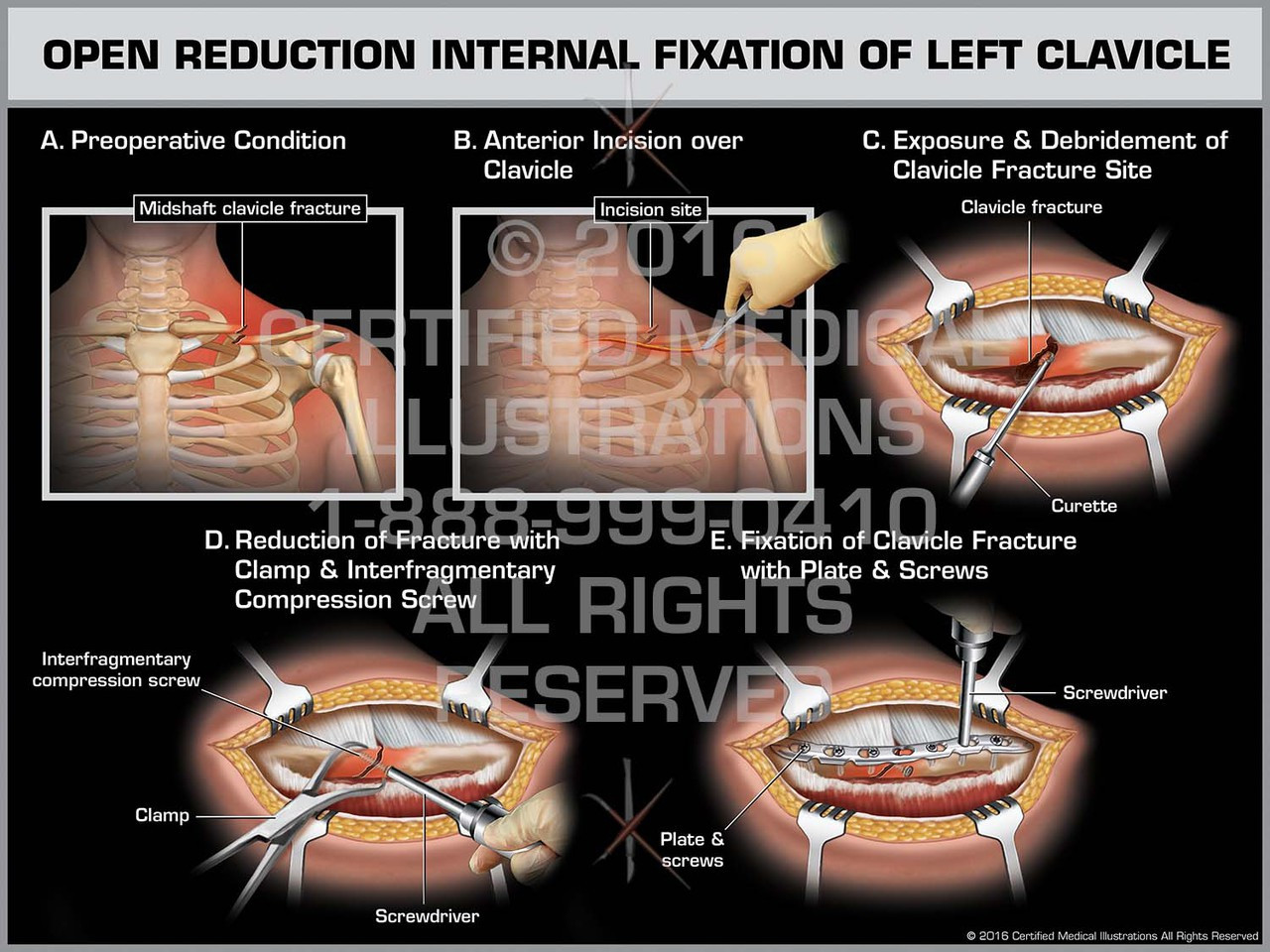 Open Reduction Internal Fixation of Left Clavicle