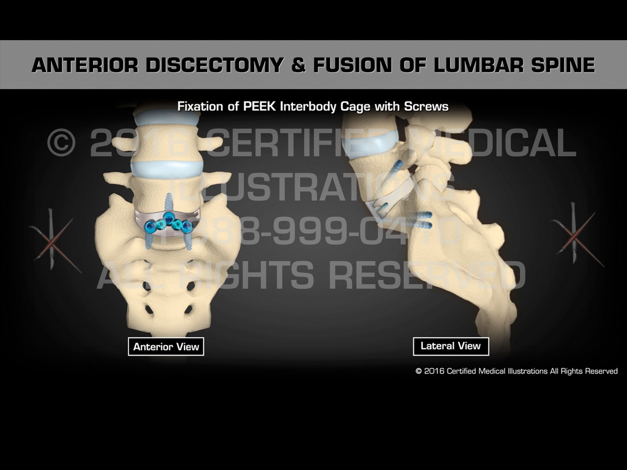 Anterior Discectomy & Fusion of Lumbar Spine - Medical Animation