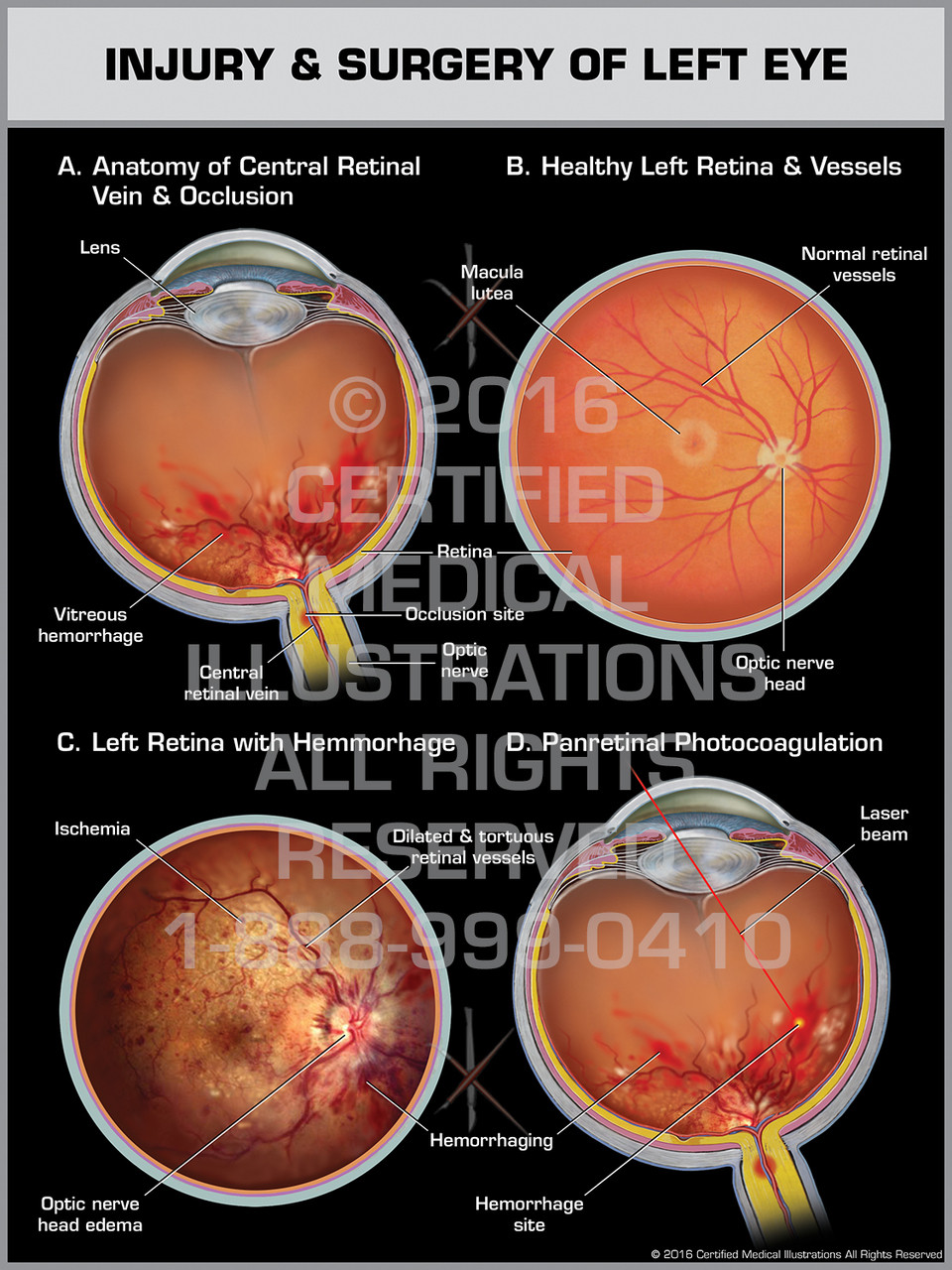Injury & Surgery of Left Eye - Print Quality Instant Download