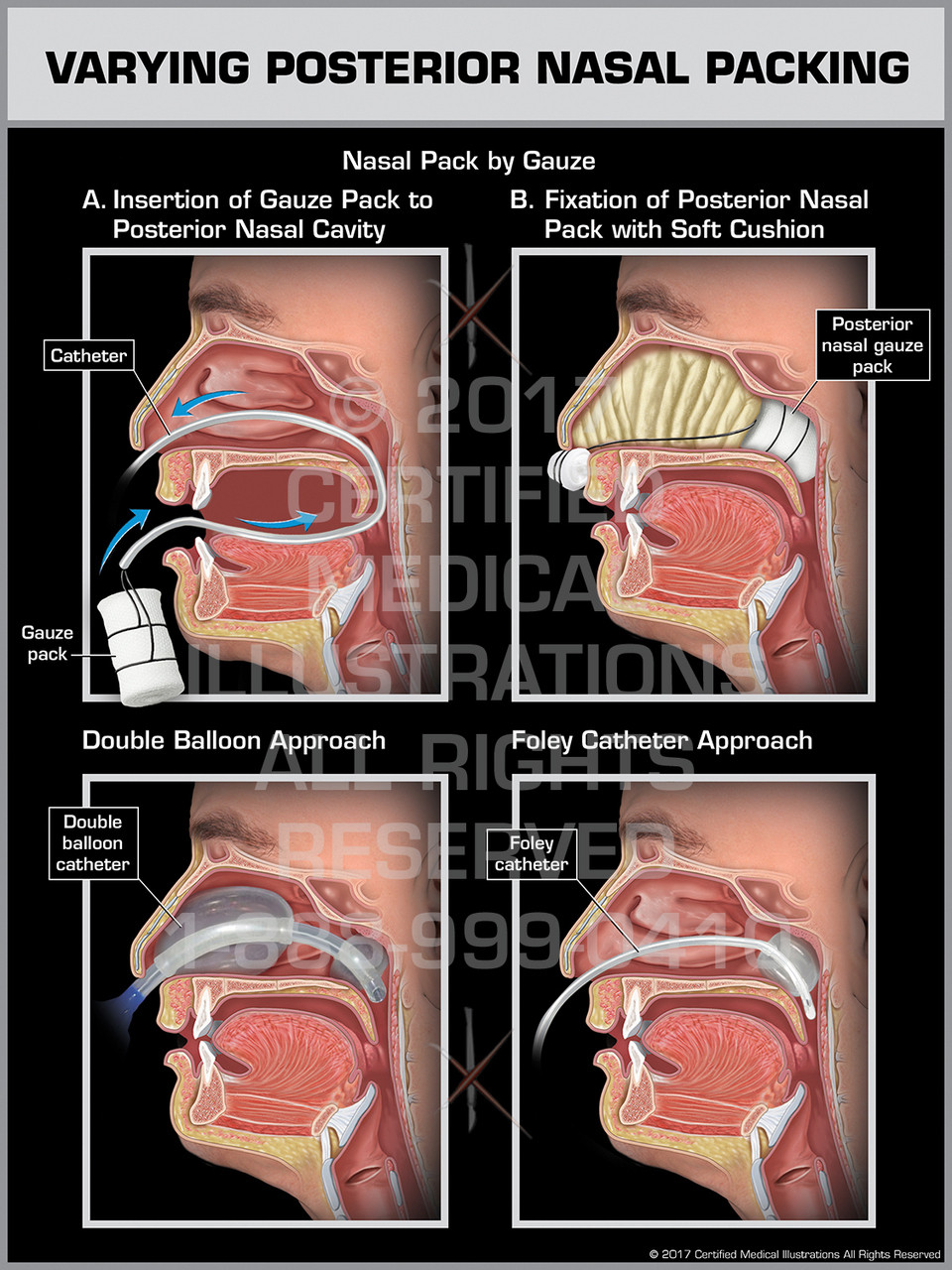 Varying Posterior Nasal Packing