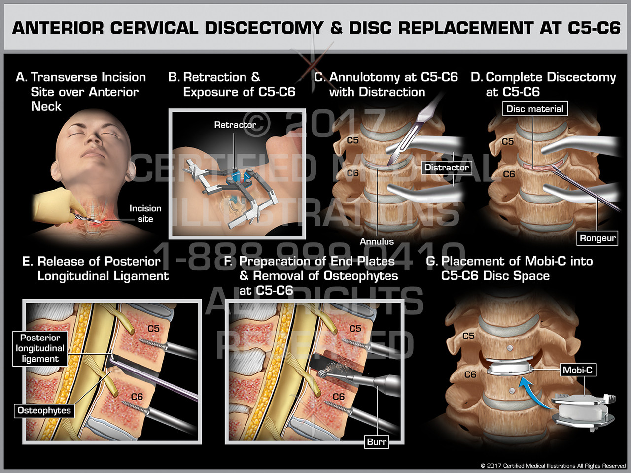 Anterior Cervical Discectomy & Disc Replacement at C5-6