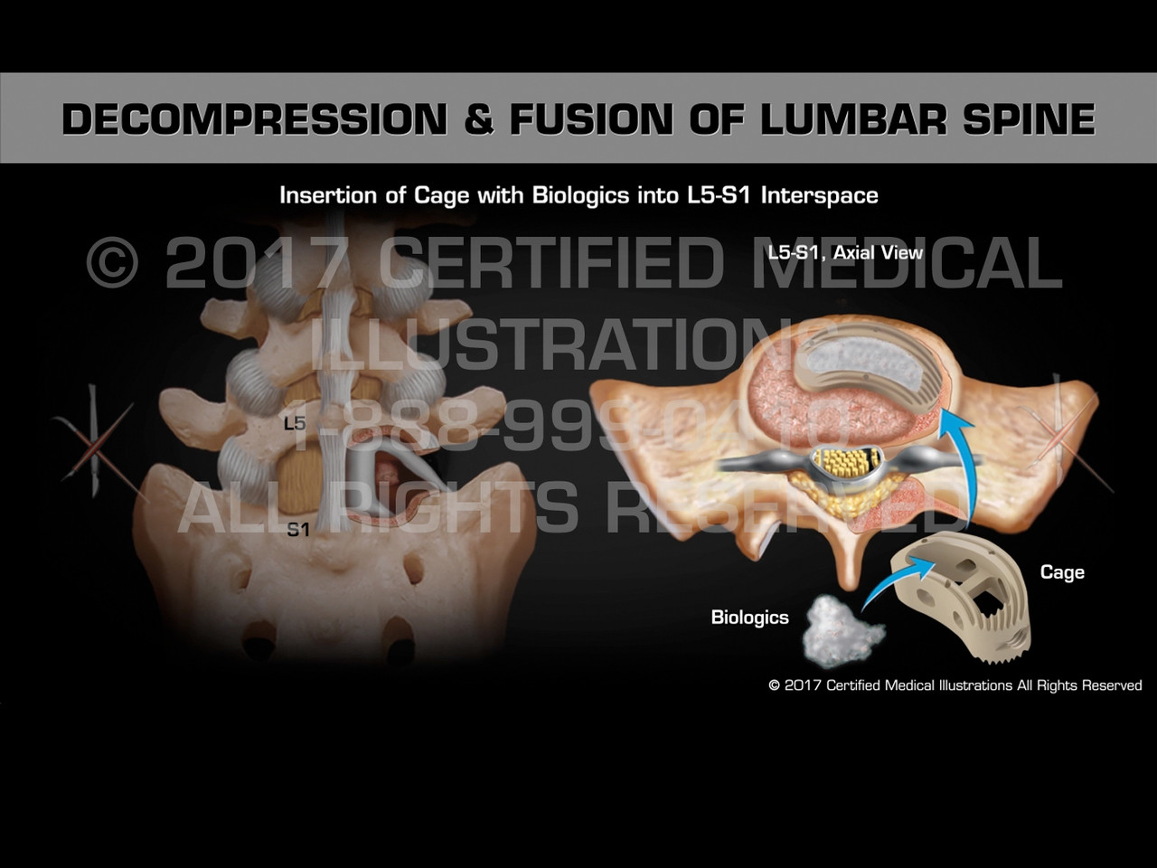 Decompression & Fusion of Lumbar Spine - Medical Animation
