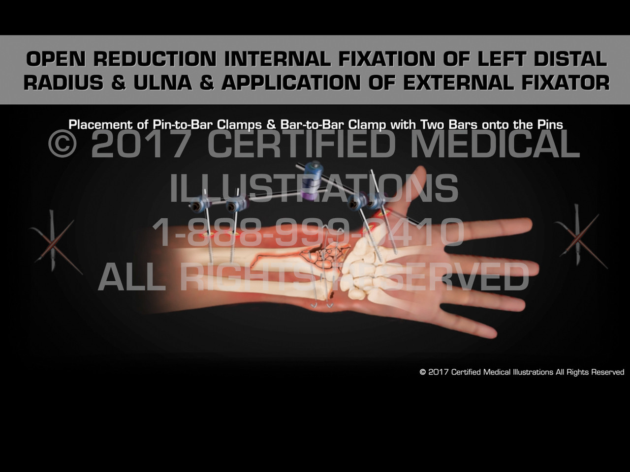 Open Reduction Internal Fixation of Left Distal Radius & Ulna ...