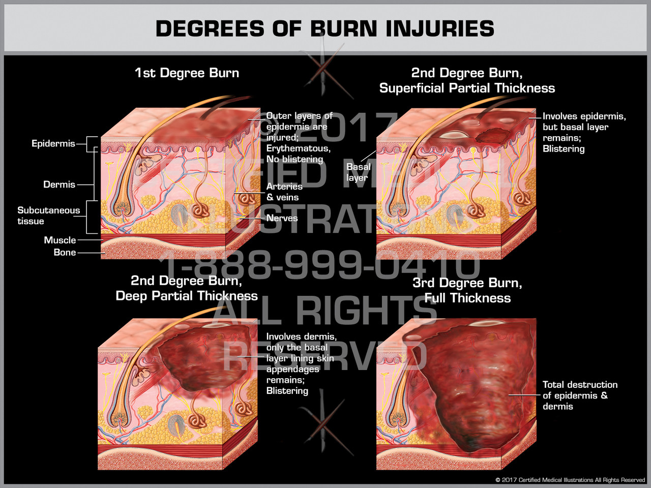Degrees of Burn Injuries