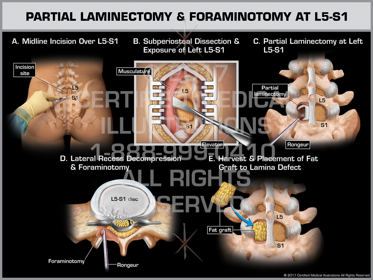 Partial Laminectomy & Foraminotomy at L5-S1 - Print Quality Instant ...