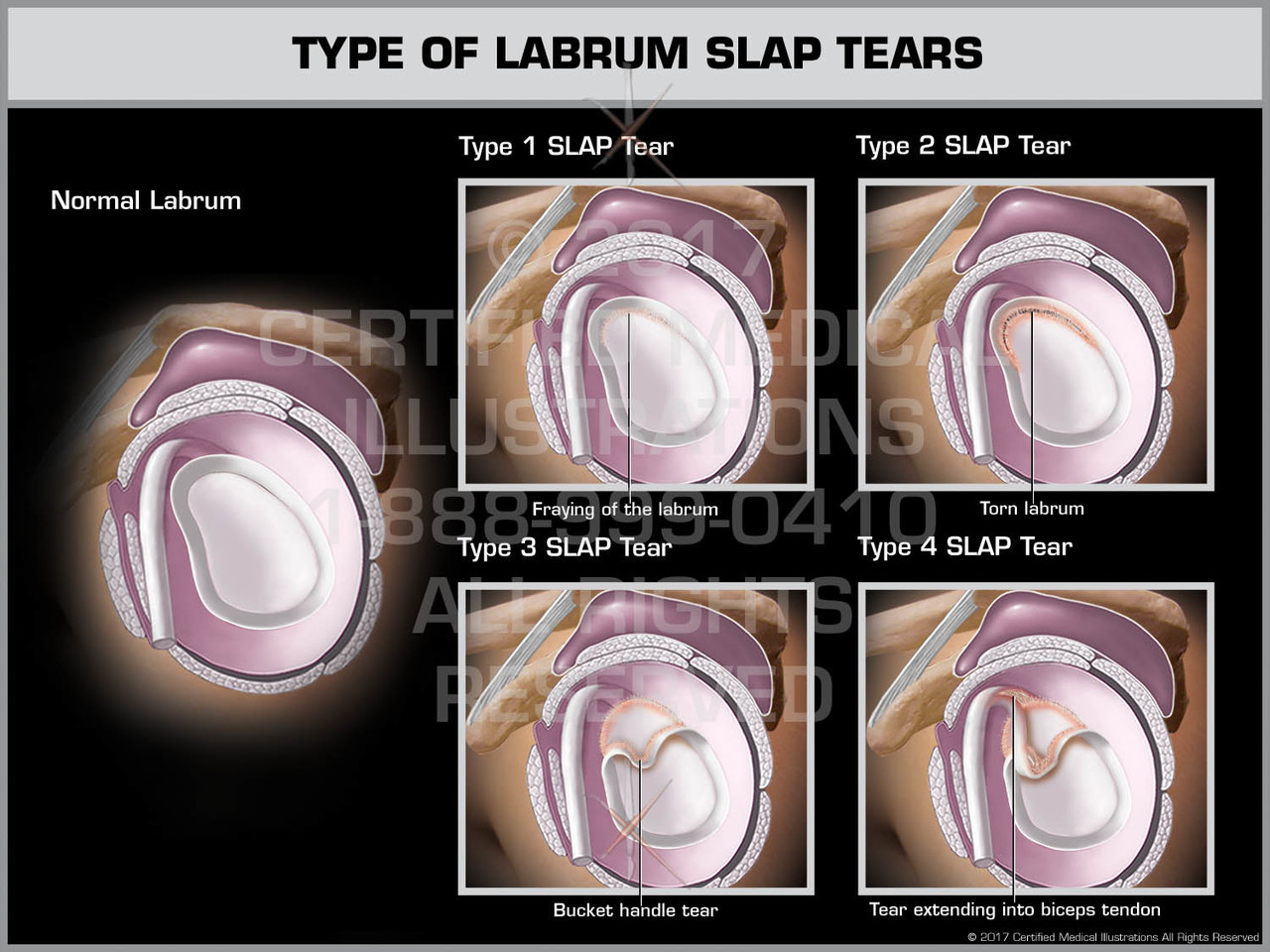 Type of Labrum SLAP Tears