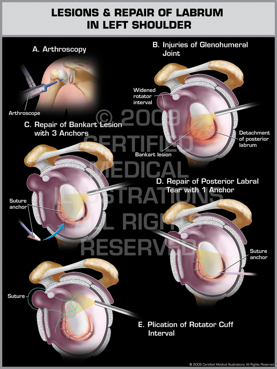 Lesions & Repair of Labrum in Left Shoulder