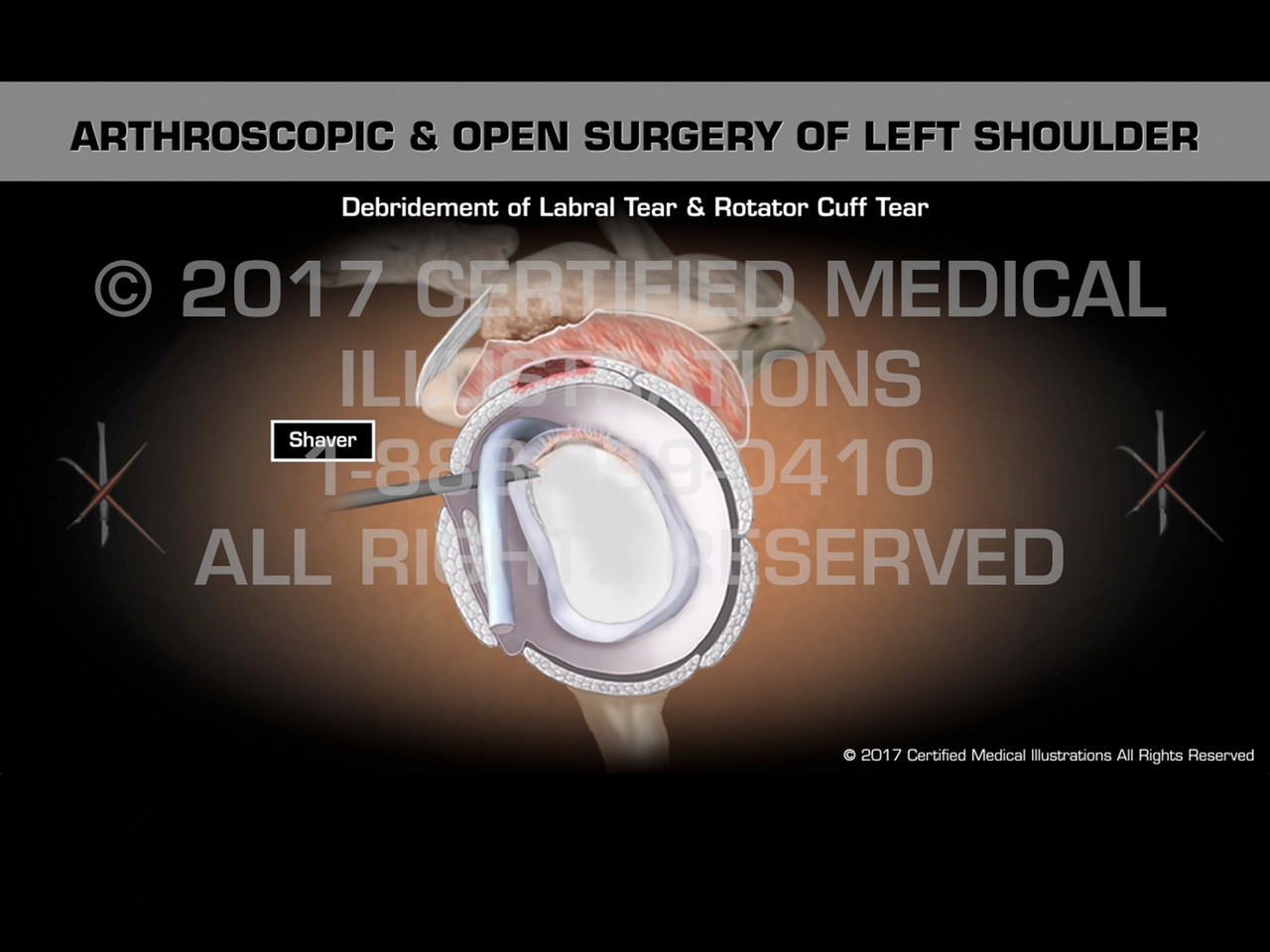 Arthroscopic & Open Surgery of Left Shoulder - Medical Animation