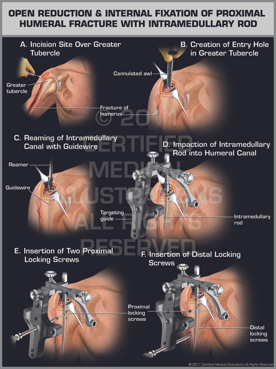 ORIF of Proximal Humeral Fracture with Intramedullary Rod