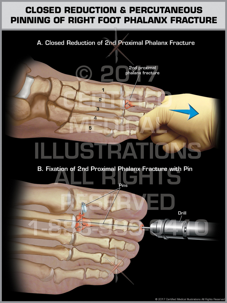 Closed Reduction & Percutaneous Pinning of Right Foot Phalanx Fracture