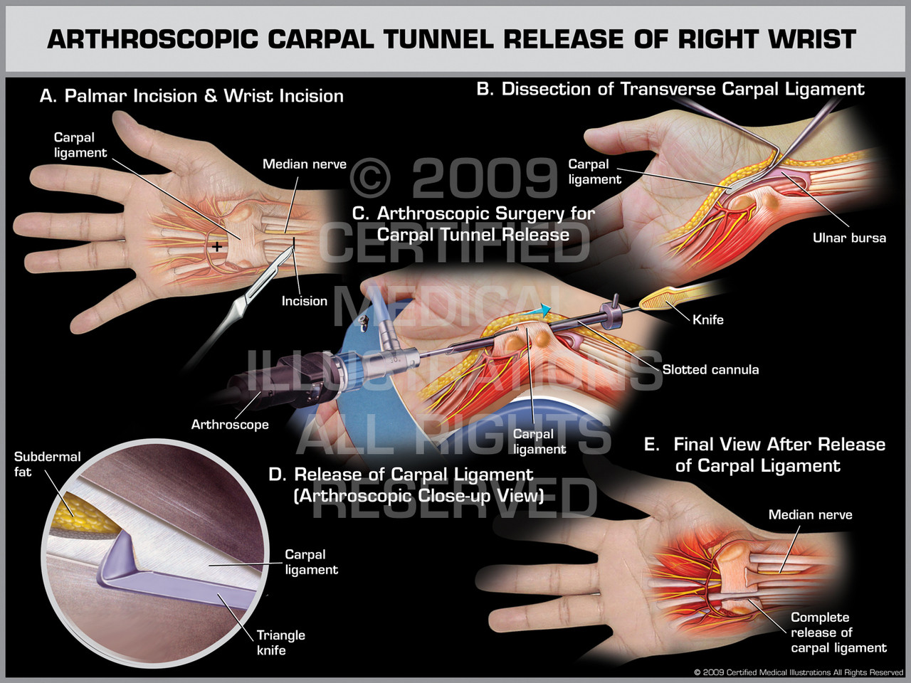 Arthroscopic Carpal Tunnel Release of Right Wrist