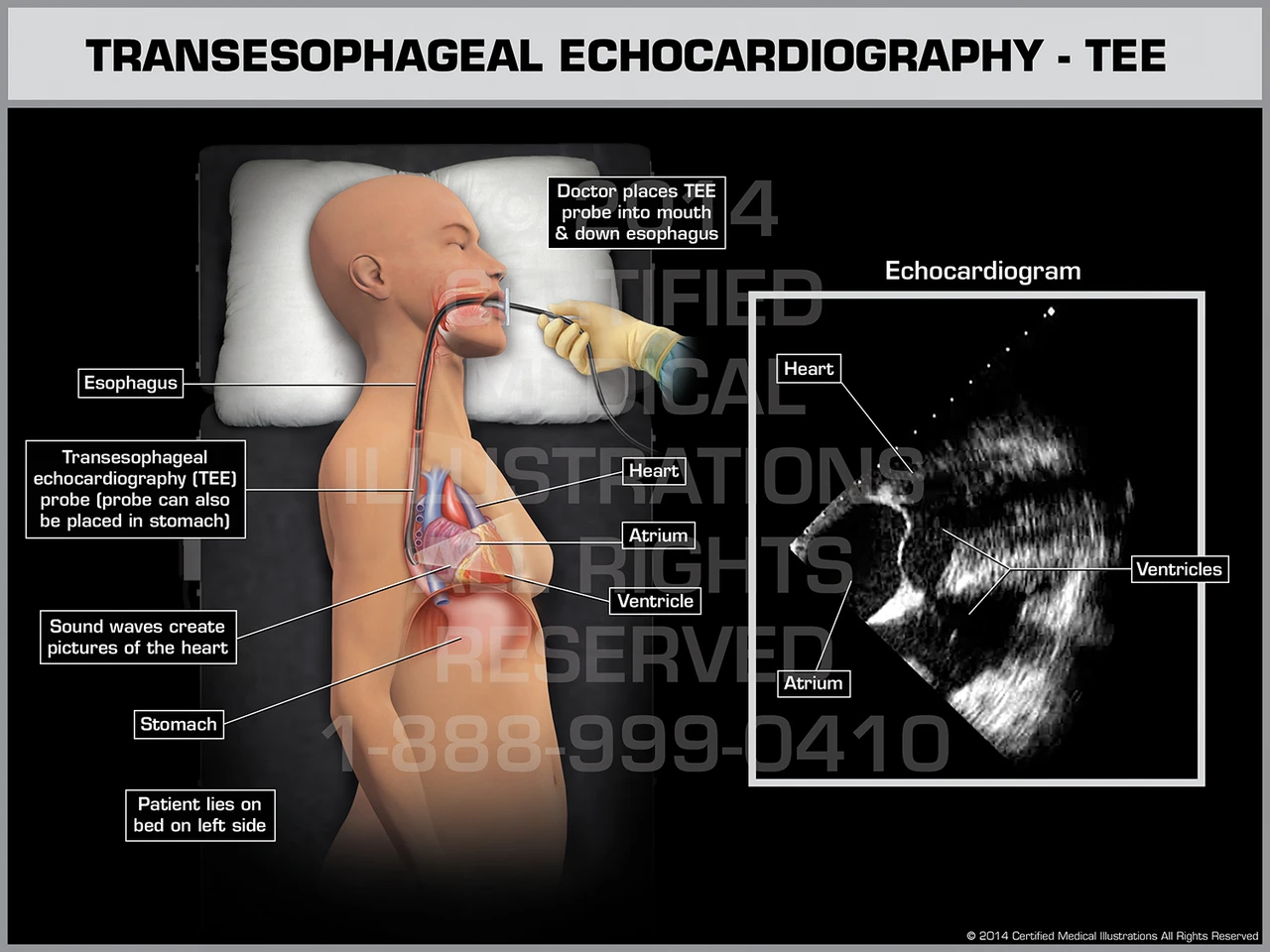 Transesophageal Echocardiography - TEE Female