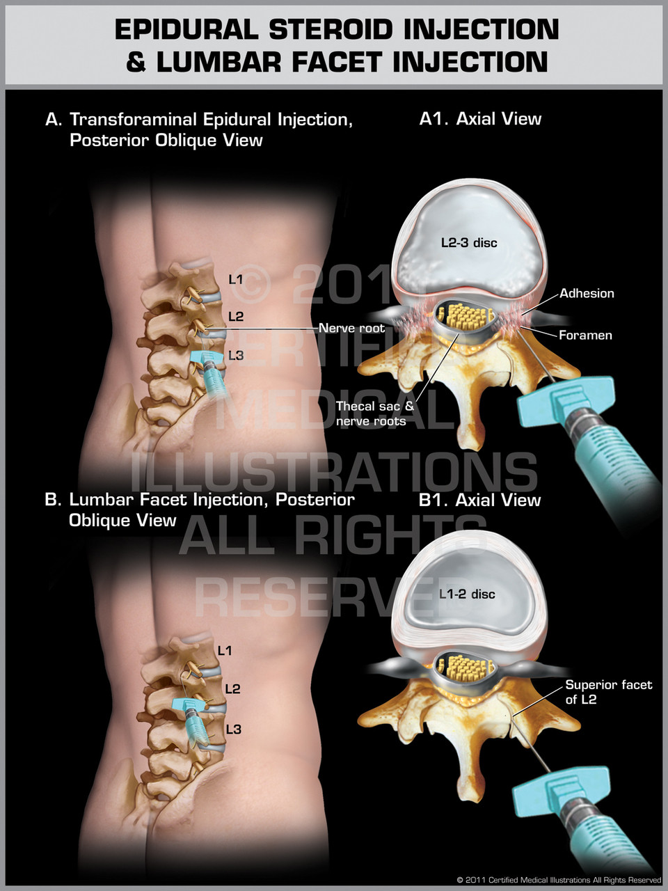 Epidural Steroid Injection & Lumbar Facet Injection