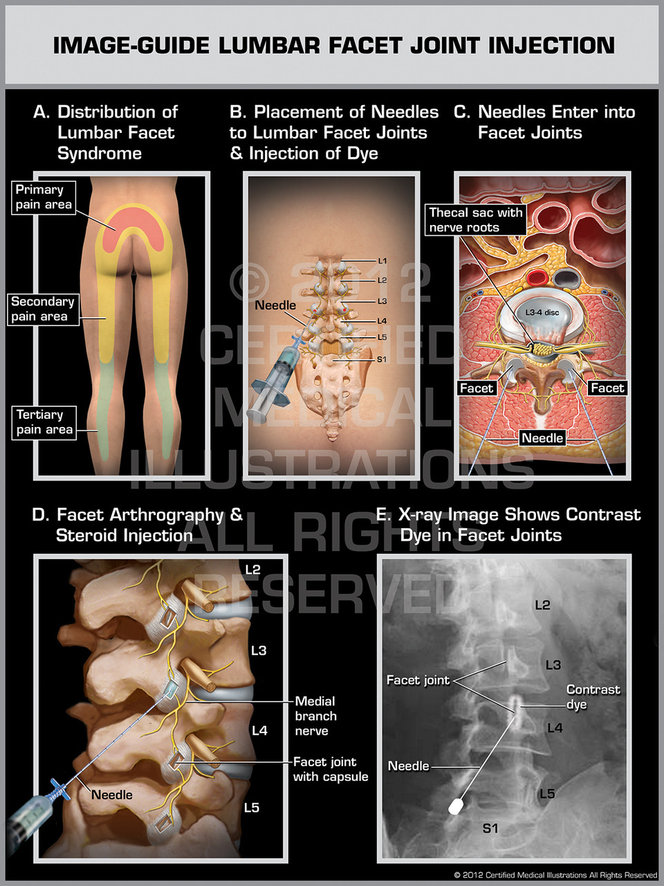 Image-Guide Lumbar Facet Joint Injection Male