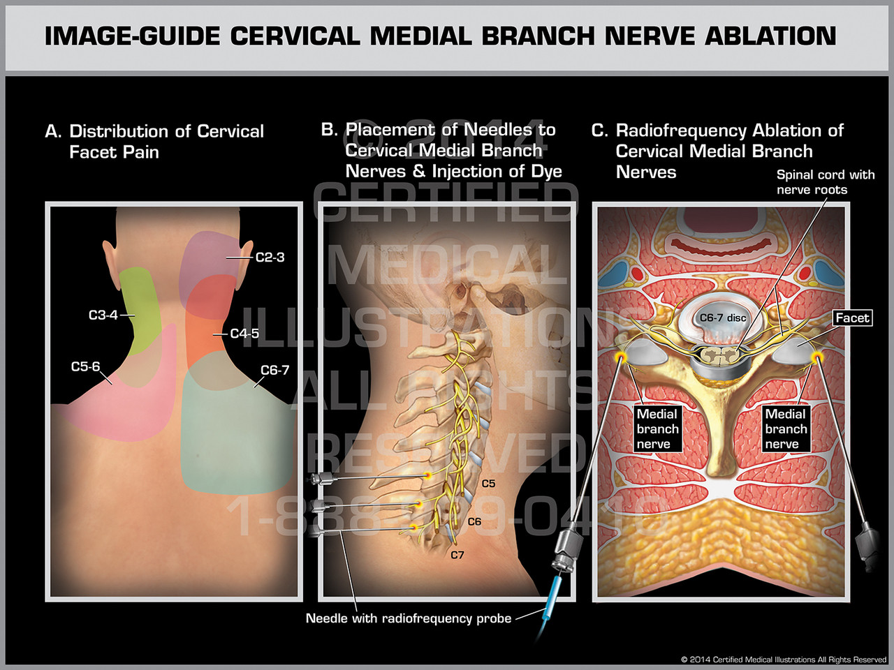 Image-Guide Cervical Medial Branch Nerve Ablation Male