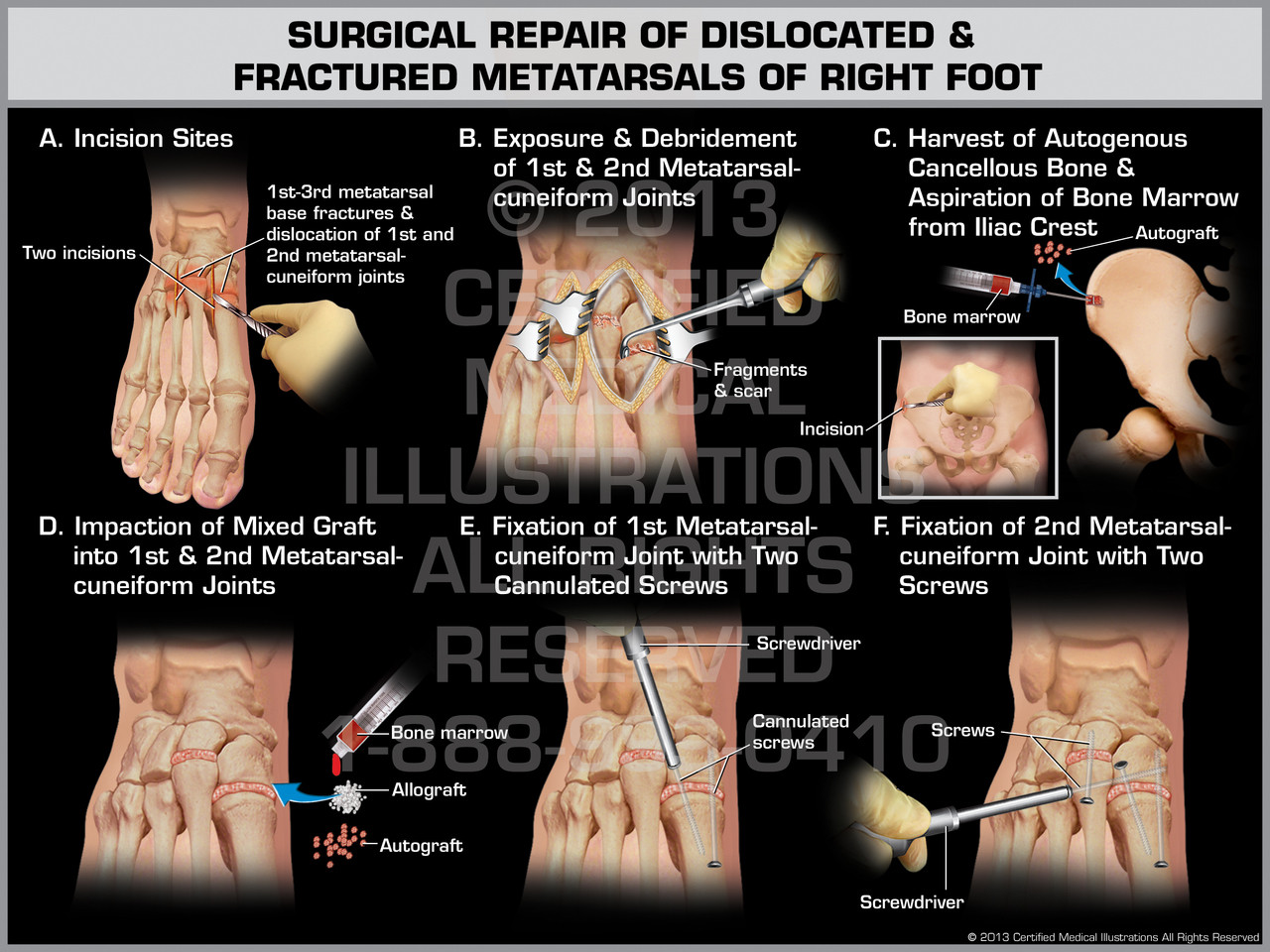 Surgical Repair of Dislocated & Fractured Metatarsals of Right Foot