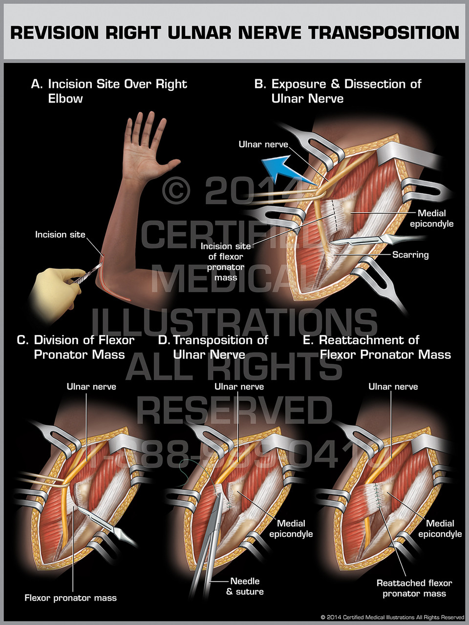 Revision Right Ulnar Nerve Transposition