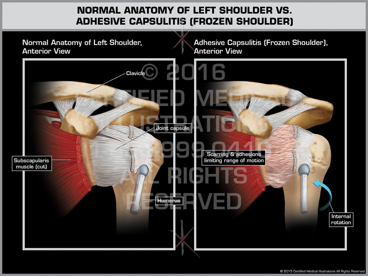 Normal Anatomy of Left Shoulder vs. Adhesive Capsulitis (Frozen Shoulder)