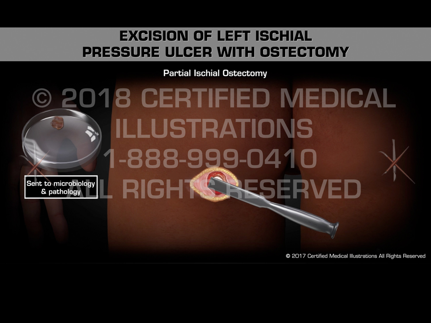 Excision of Left Ischial Pressure Ulcer with Ostectomy - Medical Animation