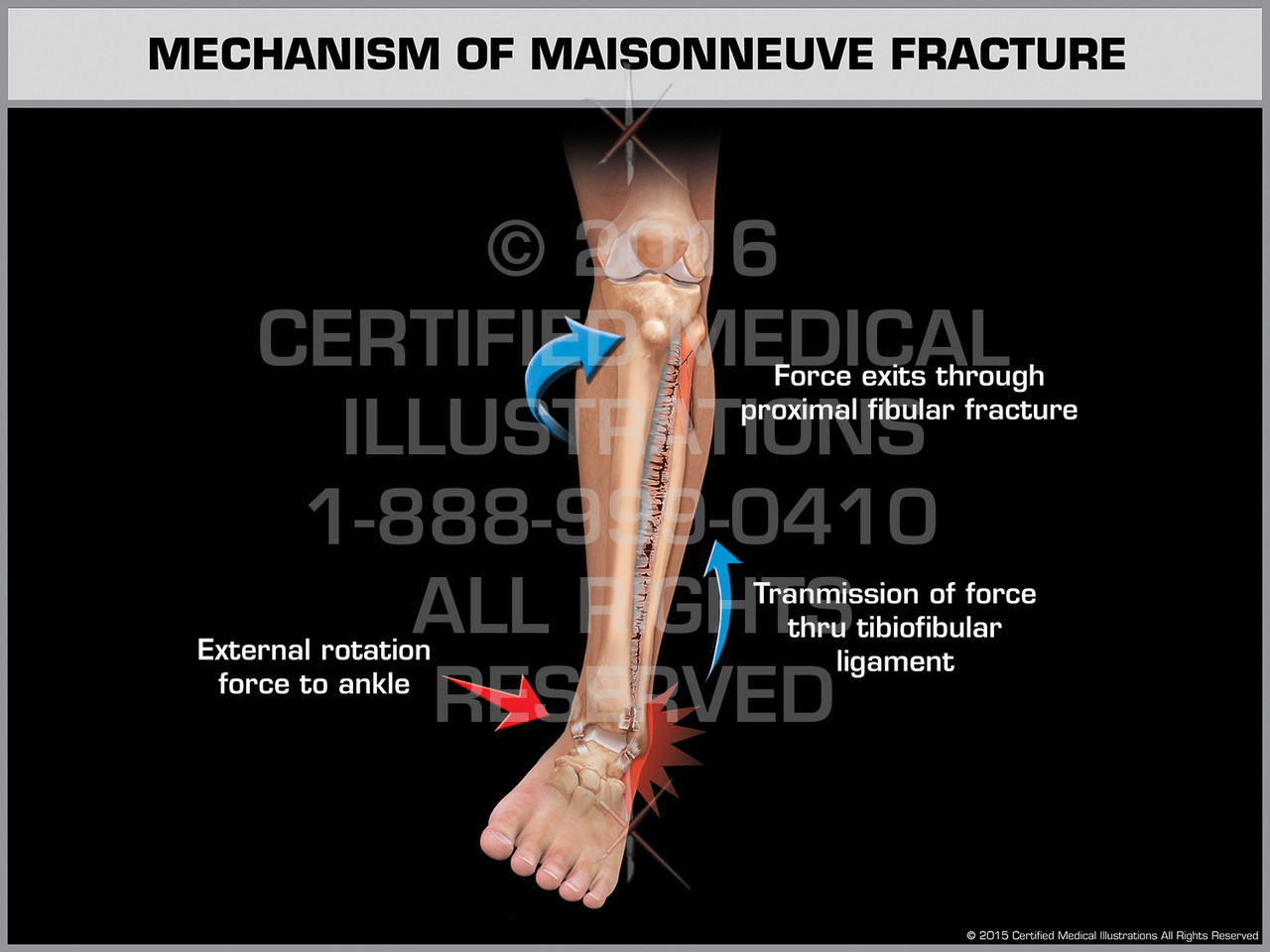 Mechanism of Maisonneuve Fracture - Print Quality Instant Download