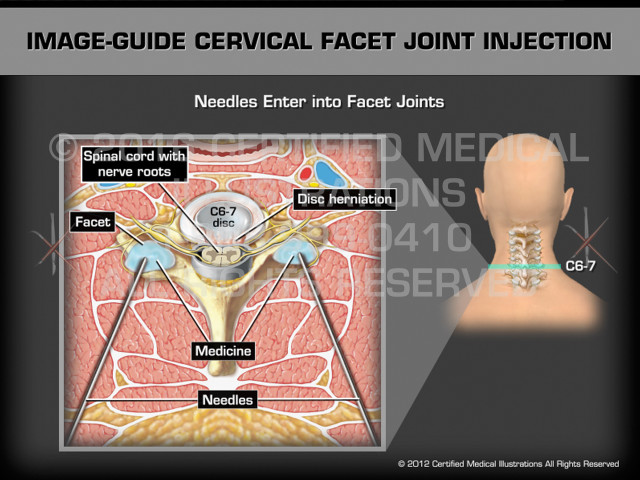 Image-Guide Cervical Facet Joint Injection - Medical Animation