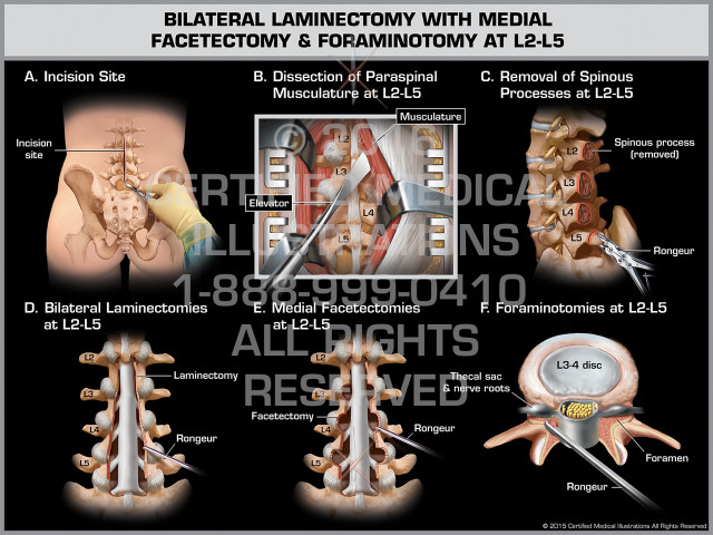 Bilateral Laminectomy with Medial Facetectomy & Foraminotomy at L2-L5