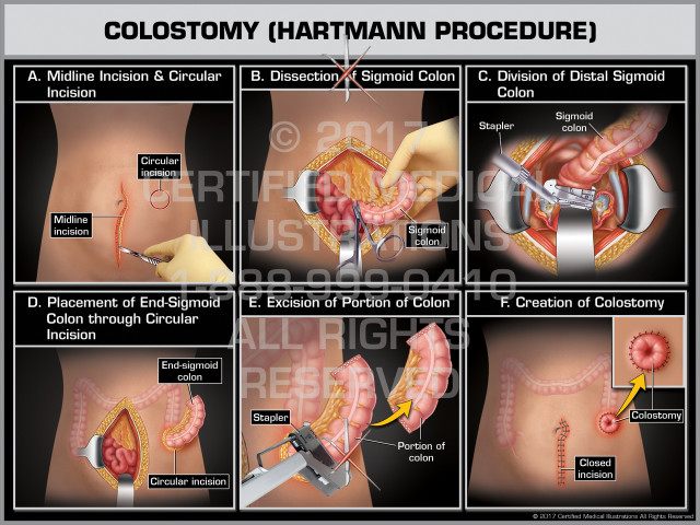 Colostomy (Hartmann Procedure)