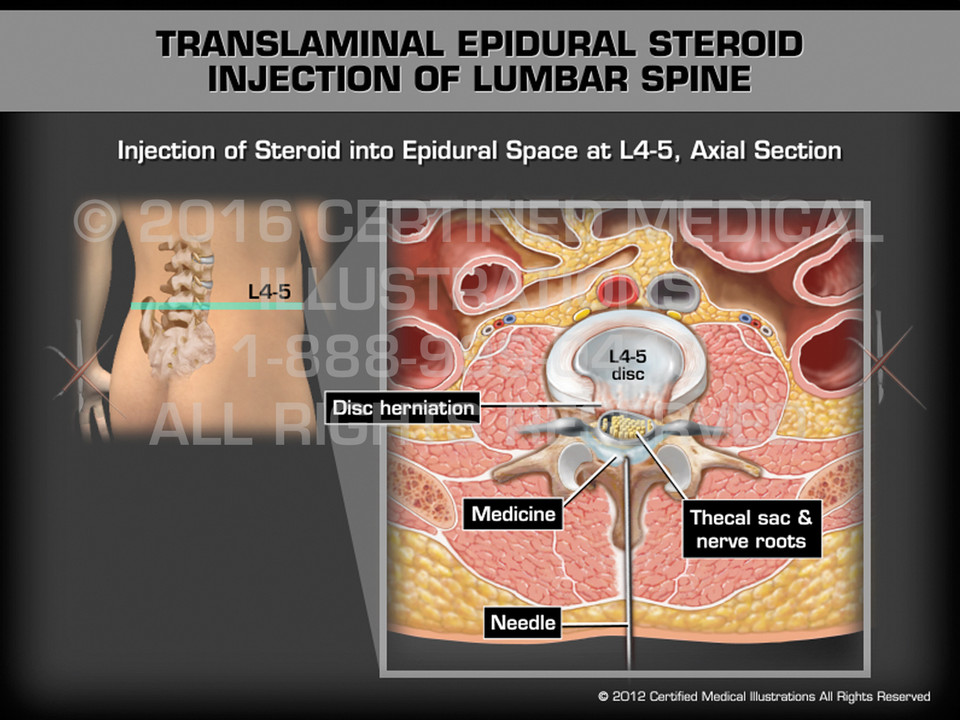Translaminal Epidural Steroid Injection of Lumbar Spine - Medical ...