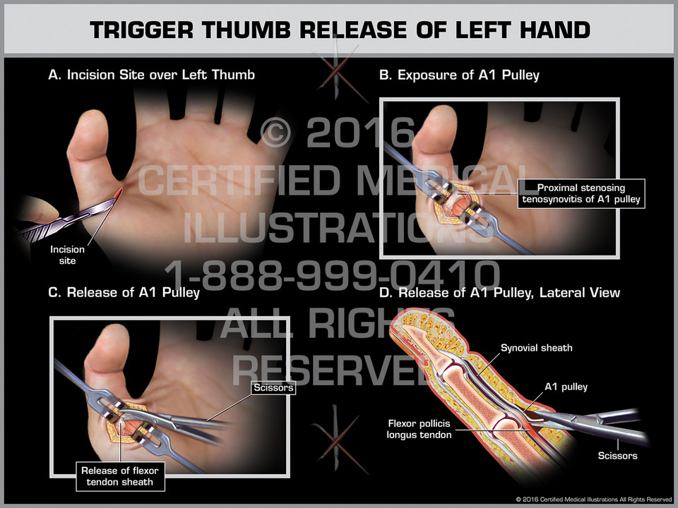 Trigger Thumb Release of Left Hand - Print Quality Instant Download