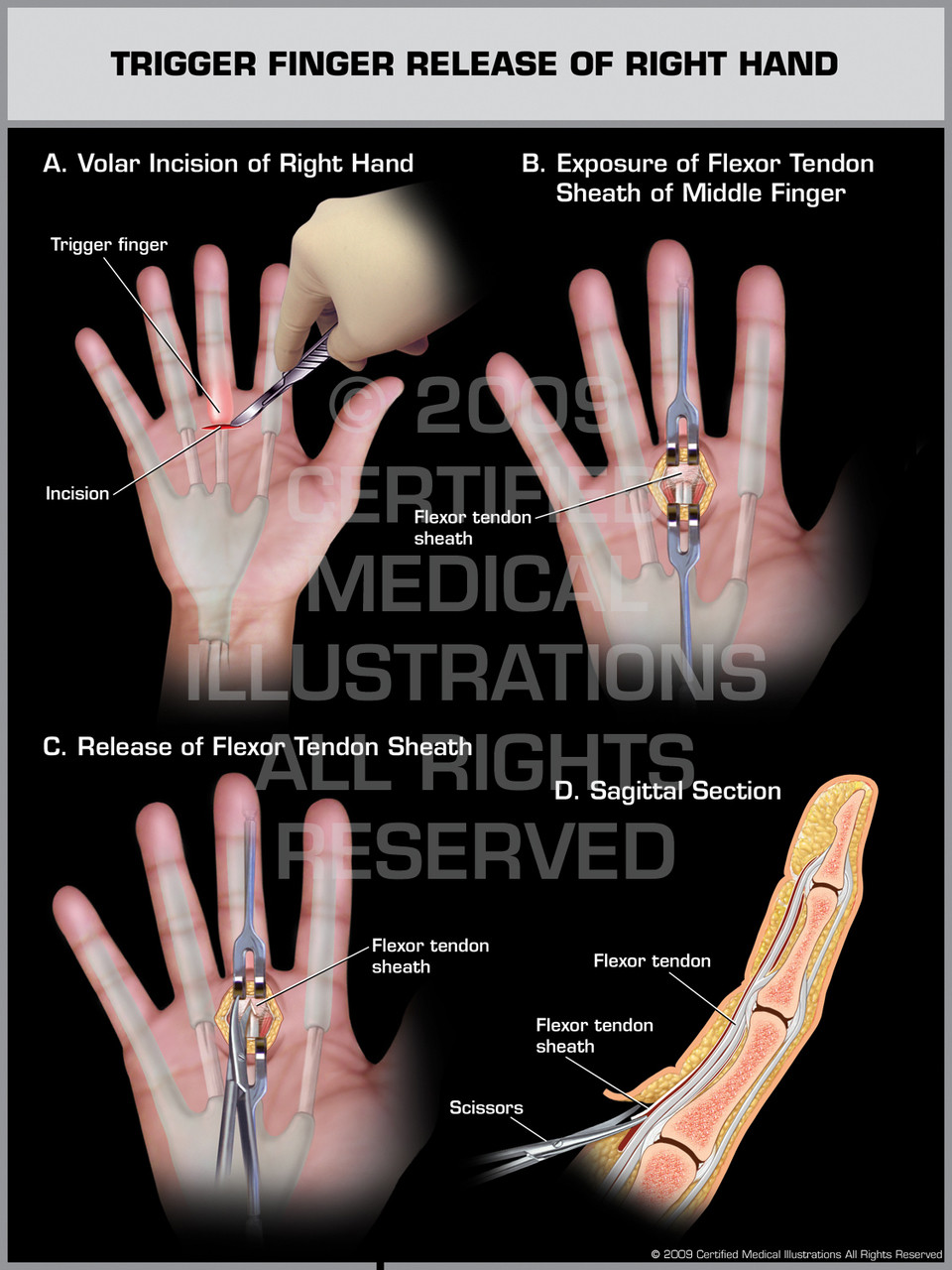 Trigger Finger Release of Right Hand
