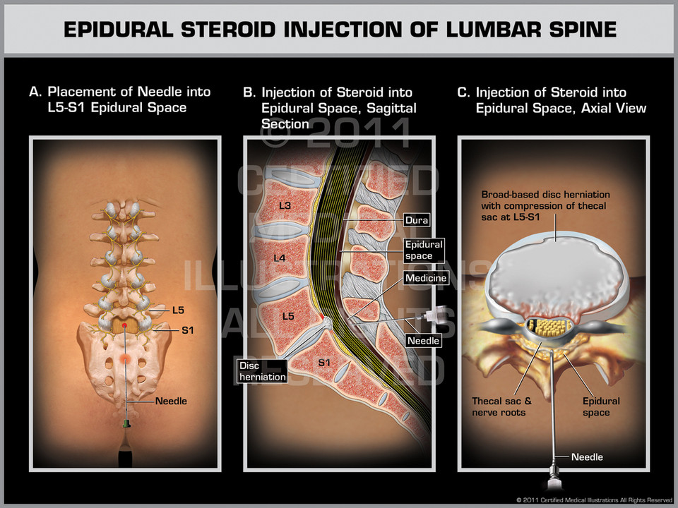 Epidural Steroid Injection of Lumbar Spine