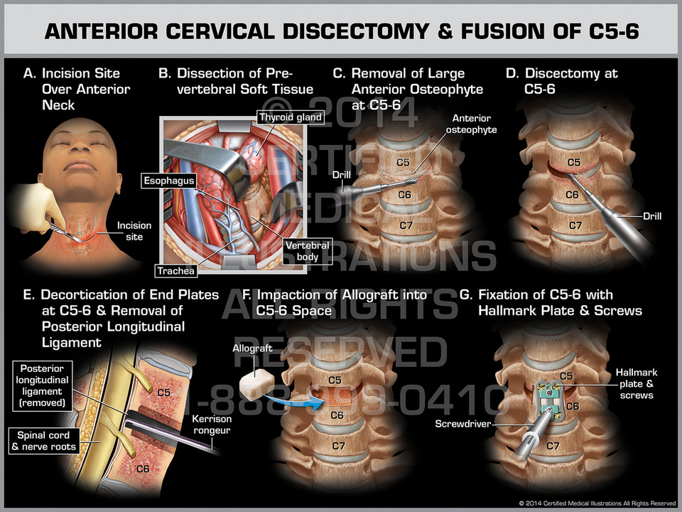 Anterior Cervical Discectomy & Fusion of C5-6 Female