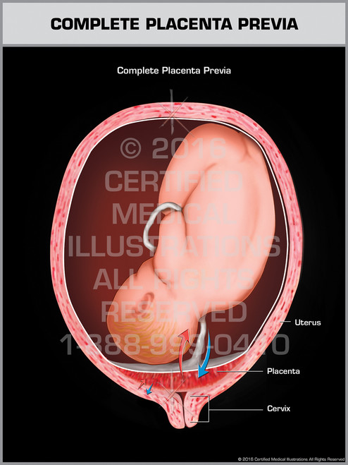 Complete Placenta Previa