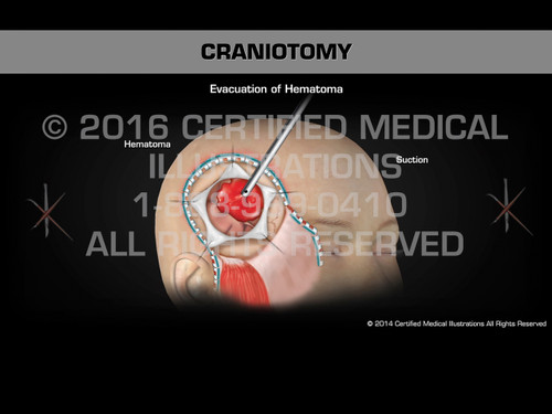 Craniotomy - Medical Animation