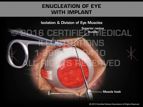Enucleation of Eye with Implant - Medical Animation