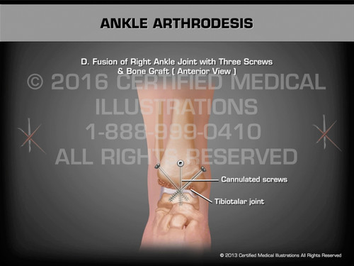 Ankle Arthrodesis - Medical Animation