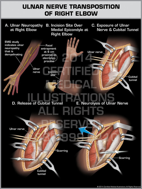 Ulnar Nerve Transposition of Right Elbow